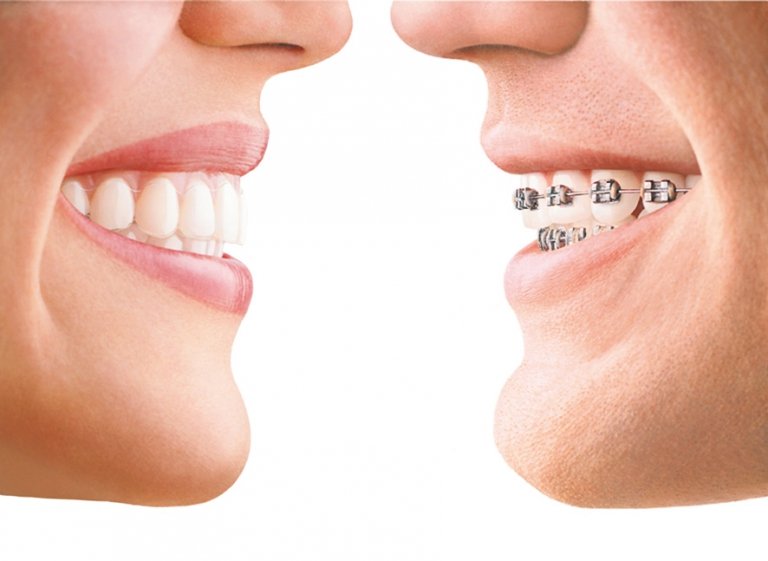 Slotjesbeugel - Dental Correct Invisalign